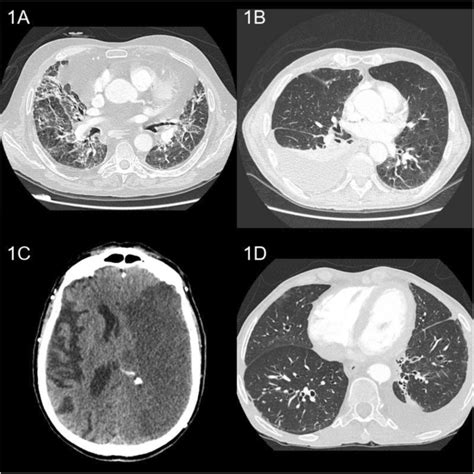 Pleural Effusion And Cryptococcus Case Series And Systematic Review Of