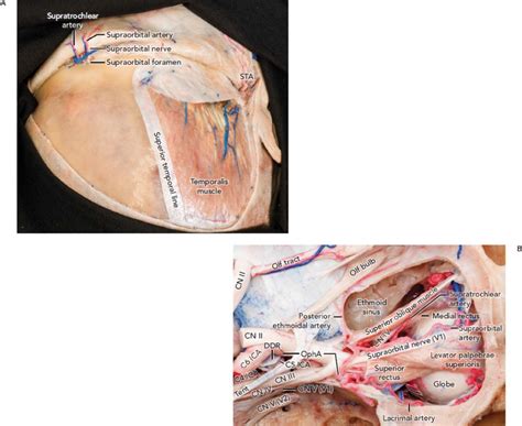 Extracranial Intracranial Bypass Neupsy Key