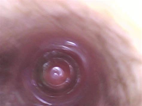 Anal Exploration Colonoscopy Rectum Hole Anus Colos Thisvid Com