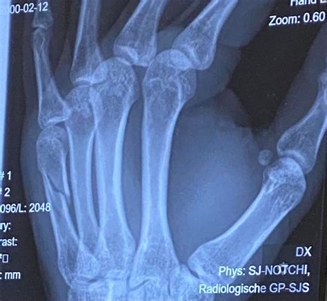 Spiral Fracture Of The 5th Metacarpal Scrolller