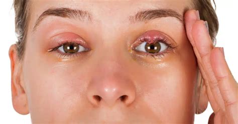 Eye Infection Treatment What Works And What Doesnt