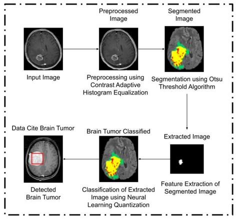 Earlier Detection Of Brain Tumor By Pre Processing Based On Histogram