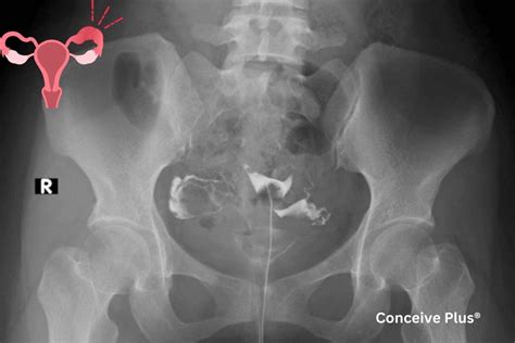 Hysterosalpingogram Hsg Cost Conceive Plus® Conceive Plus® Online Store