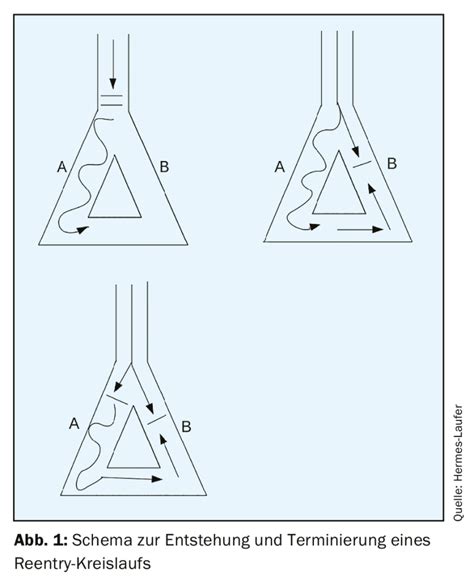 Narrow Complex Tachycardia Differential Diagnosis And Management Medizinonline