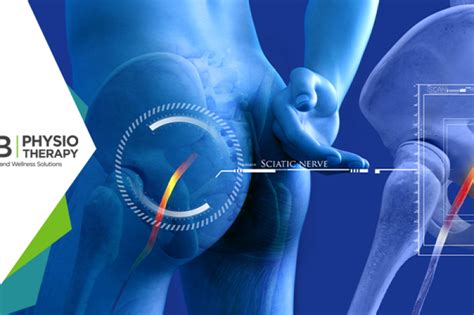 What Is Sciatica Symptoms Causes Diagnosis And Physiotherapy