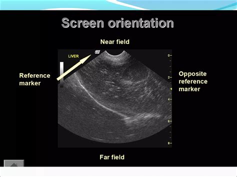 Usg Guided Fna Biopsy Ppt