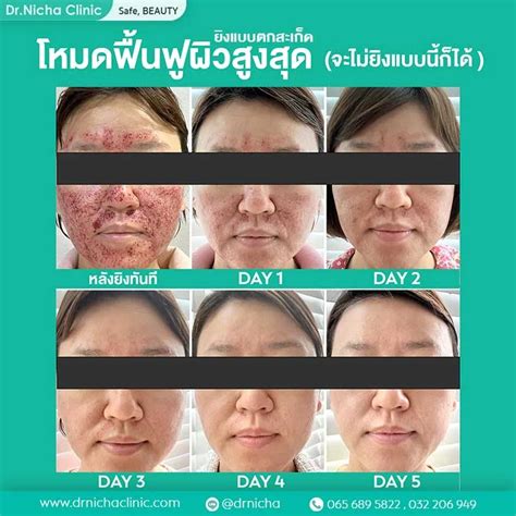 Discovery Pico Laser ผิวเนียนใส ตั้งแต่ครั้งแรก