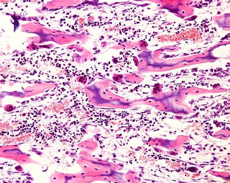 Endochondral Ossification Light Micrograph Stock Image C049 9206 Science Photo Library
