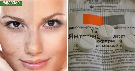 სუქცინის მჟავა ძალიან ეფექტურია პიგმენტაციისა და ნაოჭებისთვის