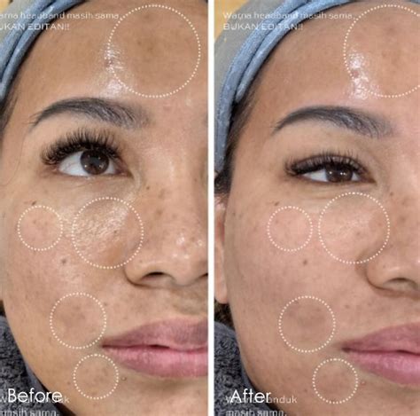 Pico Laser Laser Termahal Untuk Kulit Hilangkan Flek Jerawat