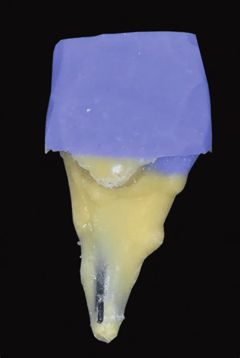 Sectioned Polyvinyl Siloxane Impression Download Scientific Diagram