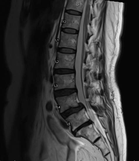 Degenerative Spondylolisthesis Spine Orthobullets