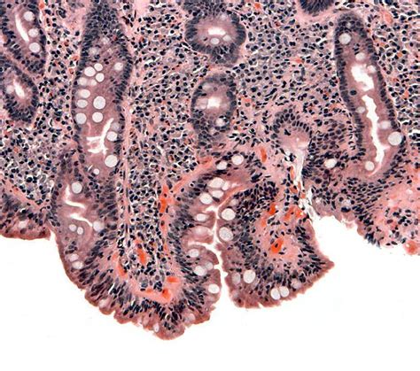 Information On Coeliac Disease From Claregalway Pharmacy—