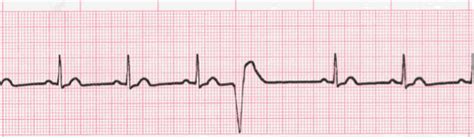 Premature Ventricular Complexes PVC S EKG Lesson 315
