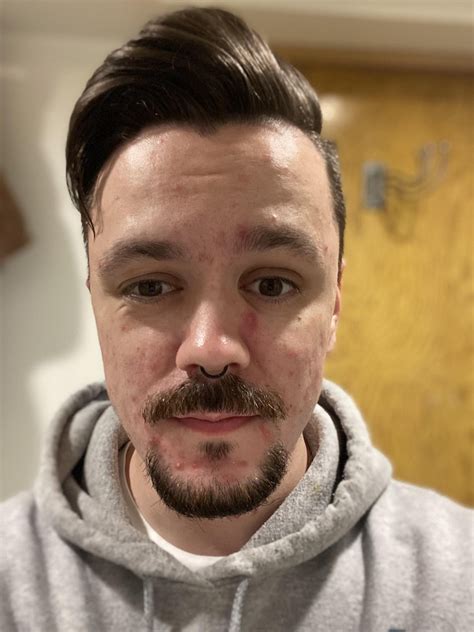 Lip Pimples Using Aquaphor A Lot On Lips And Surrounding Areas If Anyone Has Had This Issue