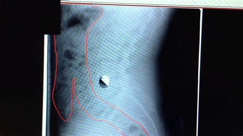 Constipation Poop On X Ray Dr Alan Nathans Youtube