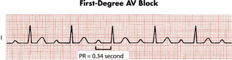 First Degree Atrioventricular Block ECG