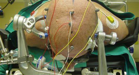 Intraoperative Neuro Monitoring