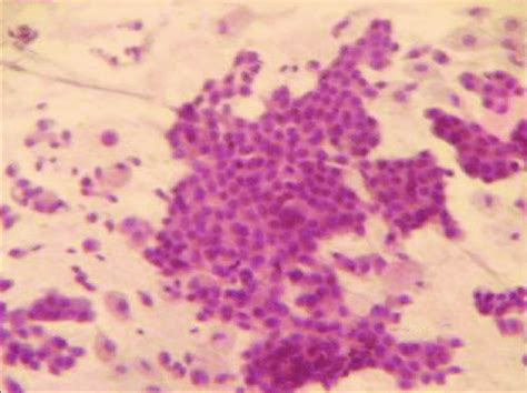Polyhedral Malignant Epithelial Cells Arranged In S H E E T S P S E U