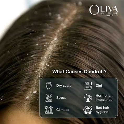 Dandruff Causes Top Triggers Symptoms And How To Stop It Naturally