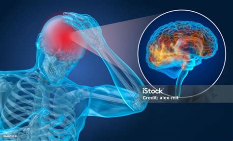 머리 통증 공격 남자 뇌 통증에서 고통 3 차원 일러스트 레이 션 대뇌에 대한 스톡 사진 및 기타 이미지 대뇌 두통 예각 Istock