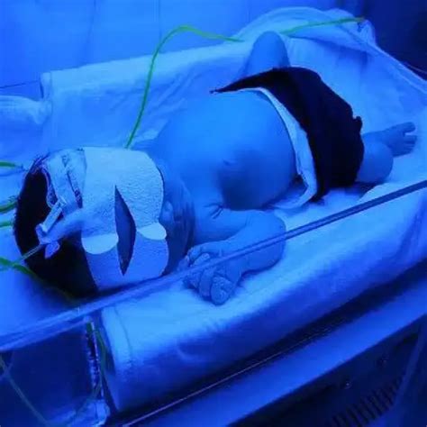Nbb2 Neonate Bilirubin Phototherapy Equipment Neonatal Jaundice