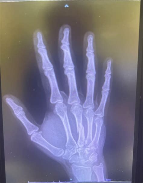 Nail Or Splint For Metacarpal Fracture R Brokenbones