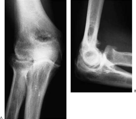 49 Radiocapitellar Arthritis Arthroscopic Versus Open
