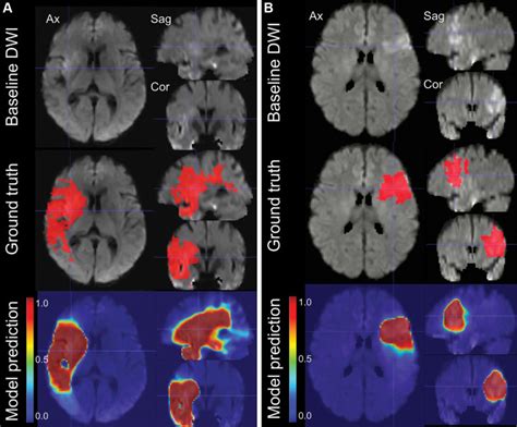 Predicting Hypoperfusion Lesion And Target Mismatch In Stroke From Diffusion Weighted Mri Using