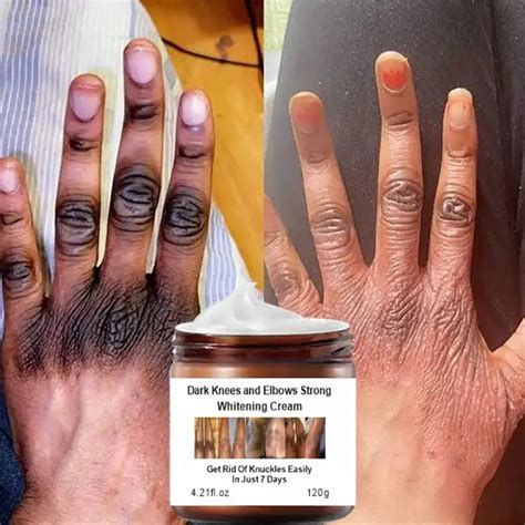 New Arrival Niacinamide Dark Knees Knuckles Elbows Armpit Whitening