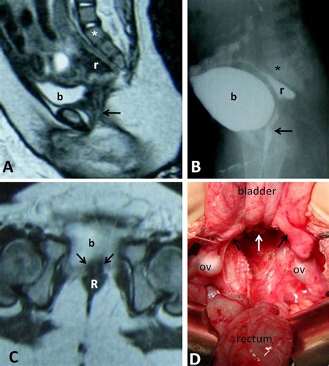 Mri Of Persistent Cloaca Can It Substitute Conventional Imaging