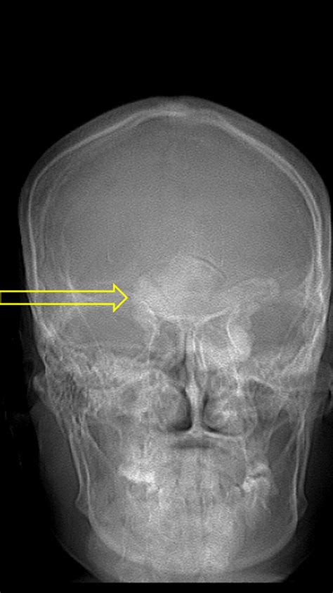 Osteomas
