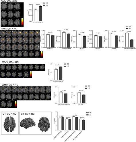 Altered Grey Matter Volume Gmv White Matter Volume Wmv And