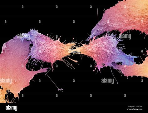 Cervical Cancer Cells Dividing Coloured Scanning Electron Micrograph Sem The Cervix Also