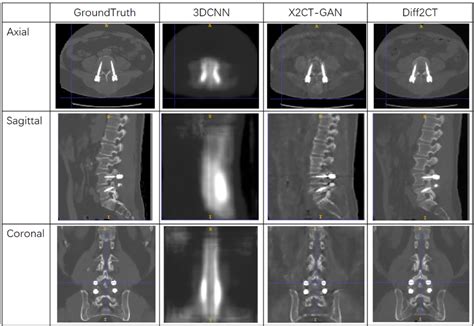 논문 리뷰 Reconstruct Spine Ct From Biplanar X Rays Via Diffusion Learning