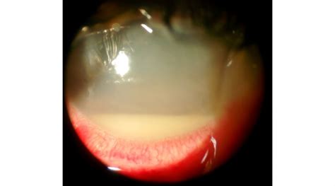 Cataract News Risk Factors For Developing Endophthalmitis After