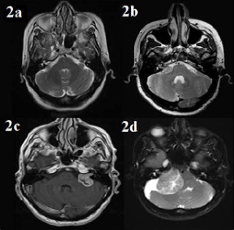 Koos Grading System For Acoustic Neuroma The 1a Is Grade 1 An