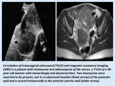 Presentation1pptx Radiological Imaging Of Uterine Lesions