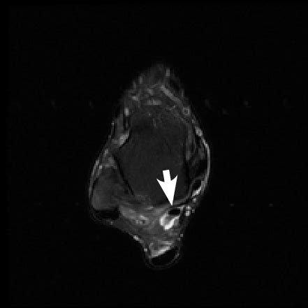 Flexor Hallucis Longus Pathology In Pais Transverse T2 Weighted Mri