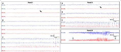 Seizure Onset Localization Using An Assortment Of Montages