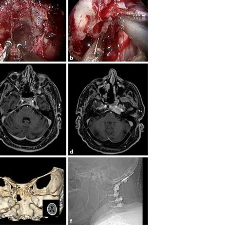 A B Intraoperative Images During The Endoscopic Endonasal Approach