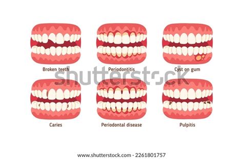 Healthy Diseased Teeth Set Diseases Tooth Stock Vector Royalty Free