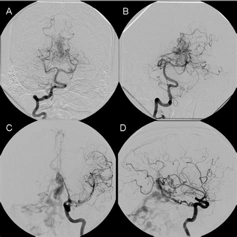 Pre Embolization Dsa Dsa Digital Subtraction Angiography Panel A Download Scientific