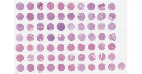 Bc03116a Liver Cancer And Liver Tissue Array Including Pathology Grade Tnm And Clinical Stage