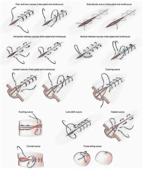 Nurses Notes Understanding Different Types Of Sutures The Nurse Wanderer Suture Techniques