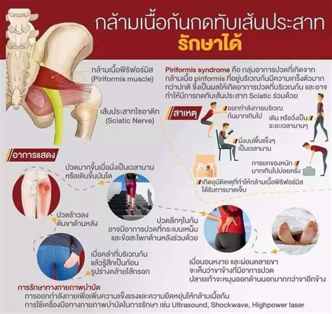 กล้ามเนื้อก้นกดทับเส้นประสาท รักษาได้ ️ Piriformis Syndrome คือ กลุ่มอาการปวดที่เกิดจาก