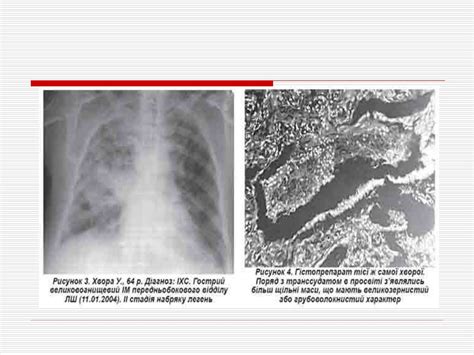 Набряк легень презентация онлайн