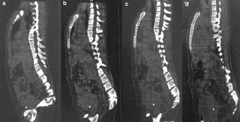 A D Sagittal Reconstructed Ct Sections There Is No Pseudoarthrosis