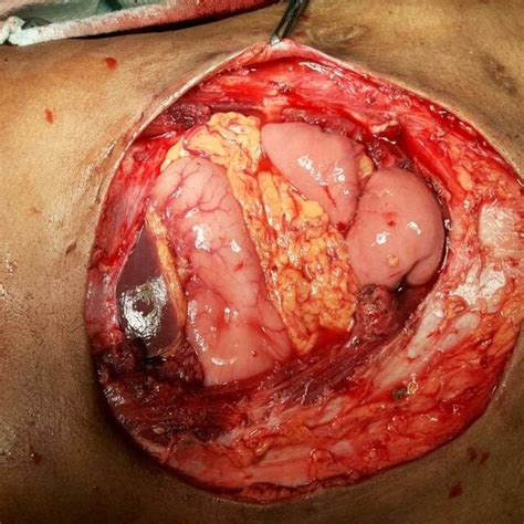 Intraoperative Photograph Showing A Large Anterior Abdominal Wall