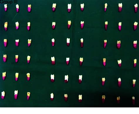 Evaluation Of Microleakage Of Different Types Of Pit And Fissure Sealants An In Vitro